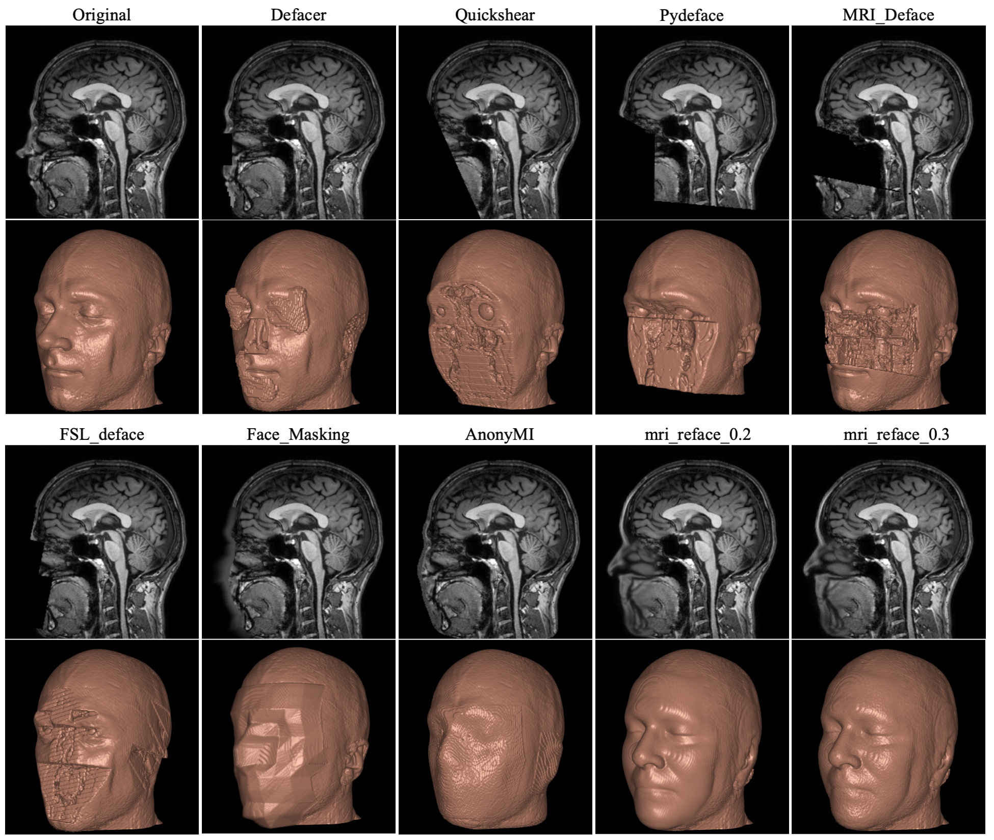 Effects of defacing whole-head MRI on brain segmentation | Chenyu Gao