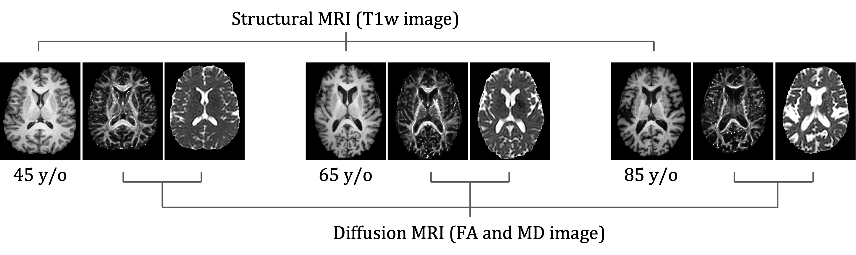 BRAID: Brain Age Identification from Diffusion MRI | Chenyu Gao